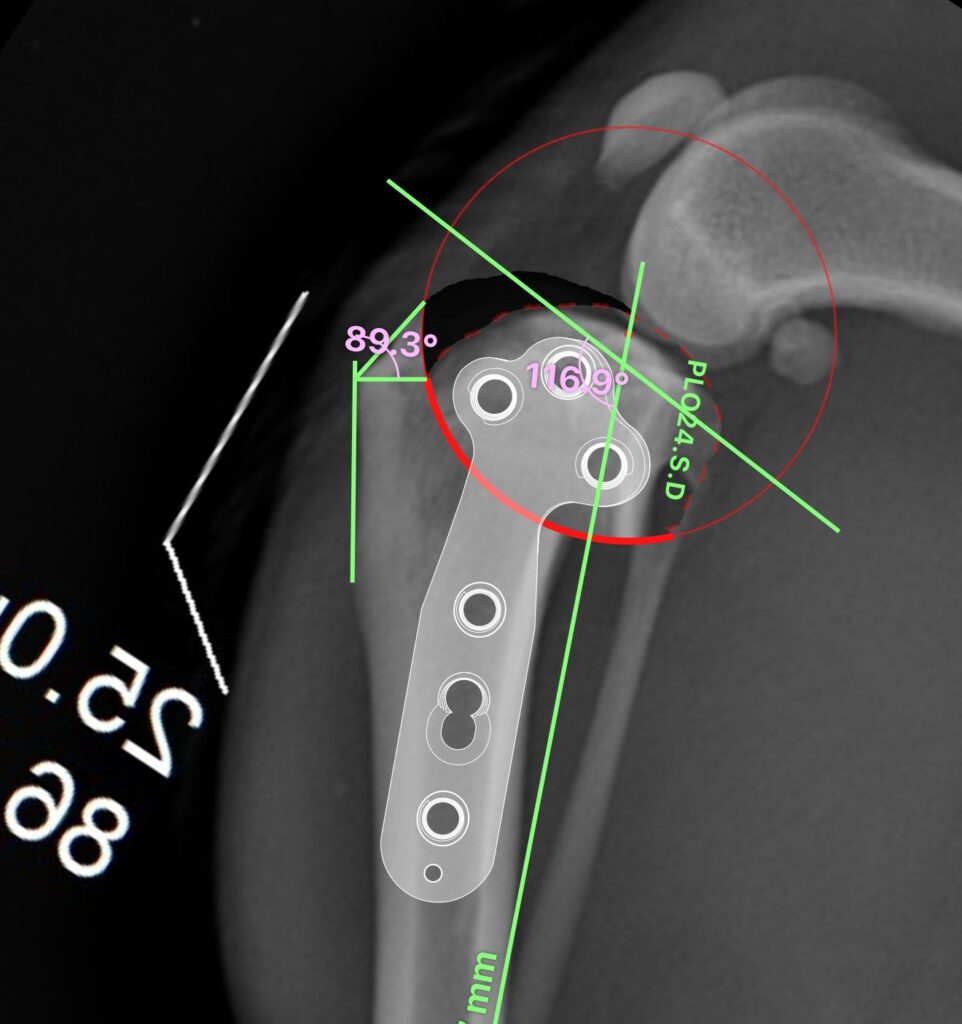 Cirurgia TPLO em Cães: 4 Vantagens da Técnica Padrão Ouro